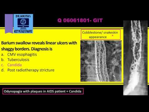 Esophageal Candidiasis Barium Swallow