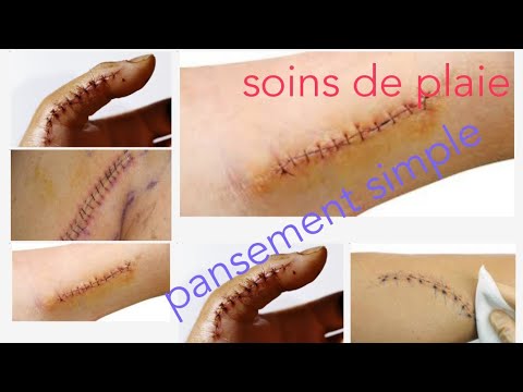 Soins infirmiers en chirurgie: soins des plaies : pansement simple ...