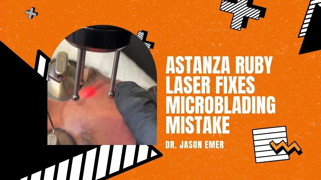 ASTANZA RUBY LASER FIXES MICROBLADING MISTAKE | Dr. Jason Emer - YouTube