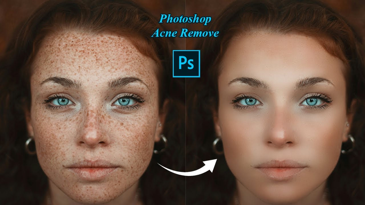 How to Remove Face Acne in Photoshop | Photoshop Easily Removed Acne in ...
