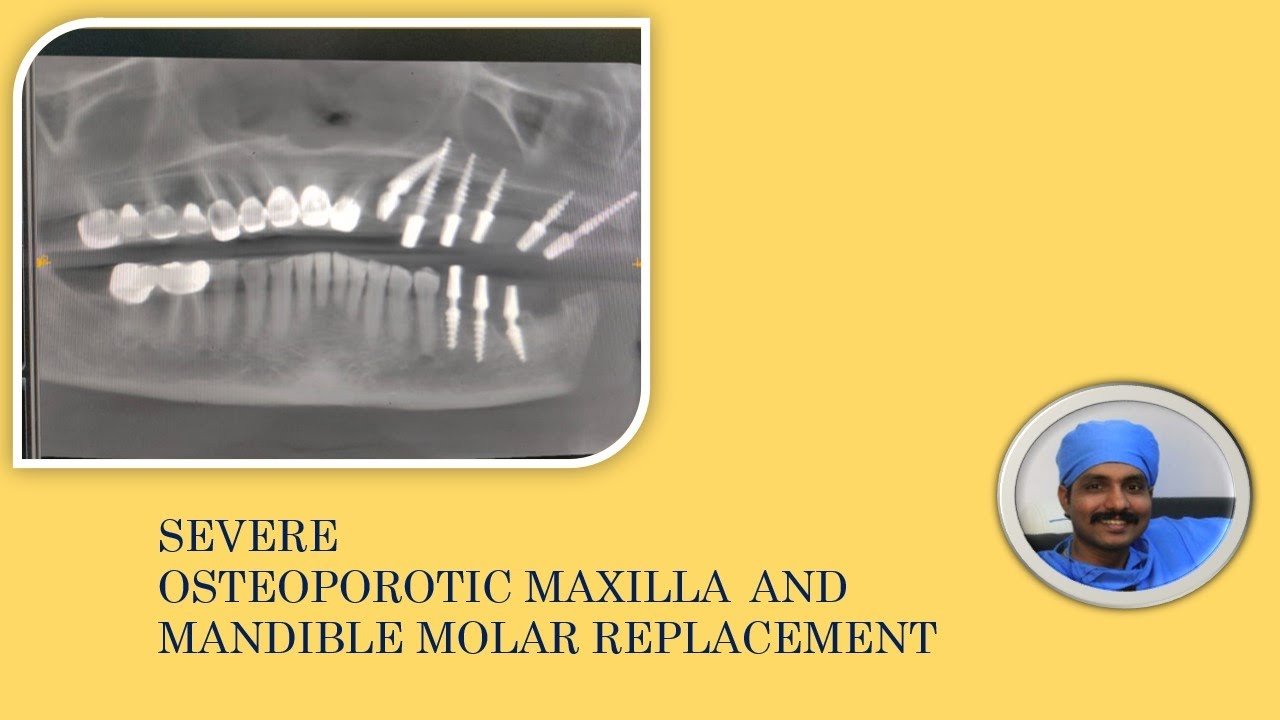 SEVERE OSTEOPOROTIC MAXILLA AND MANDIBLE MOLAR REPLACEMENT. - YouTube
