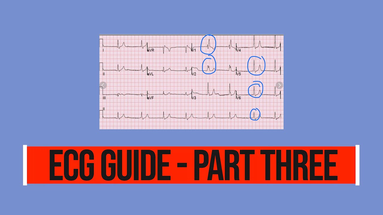 MORE ABNORMAL ECGs! Abnormal ECG interpretation guide (PART THREE ...