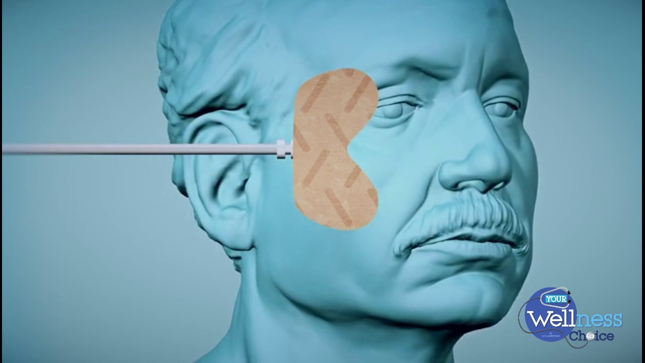 Stivax Neurostimulation - YouTube