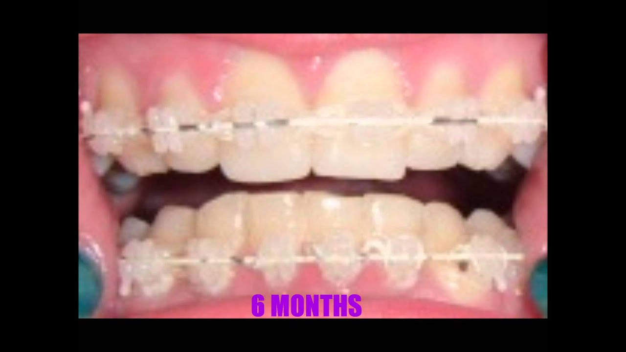6 Month Smile Transition - YouTube