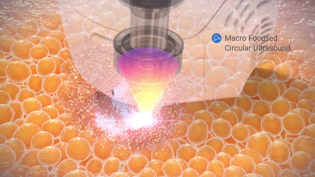 CLUEDERM ULFIT Promotion EN - YouTube