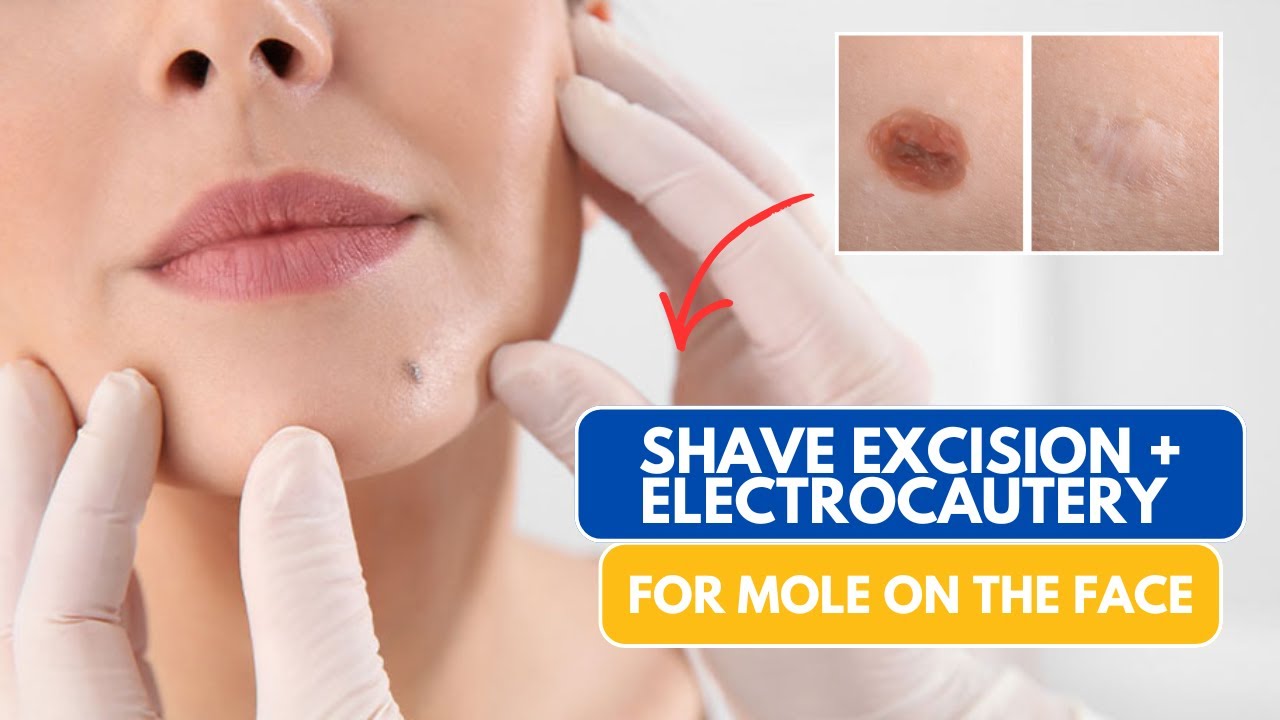 Cosmetic Mole Removal on the Face | London Ontario Dermatology Clinic ...