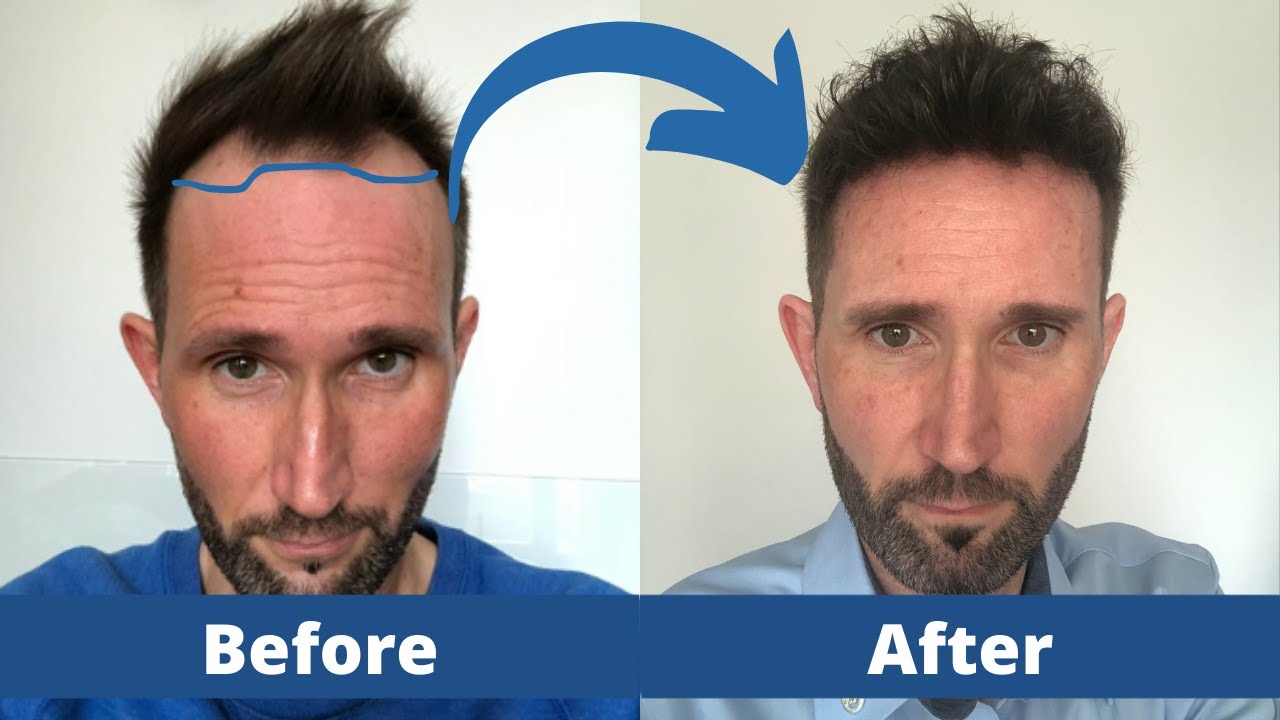 Hair Transplant Before and After - Month by Month results Elithair ...