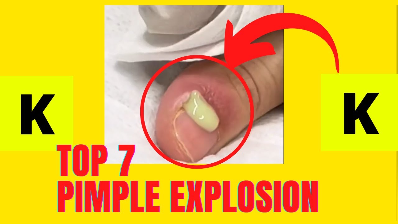 Top 7 PIMPLE EXPLOSION😱😱😱 - YouTube