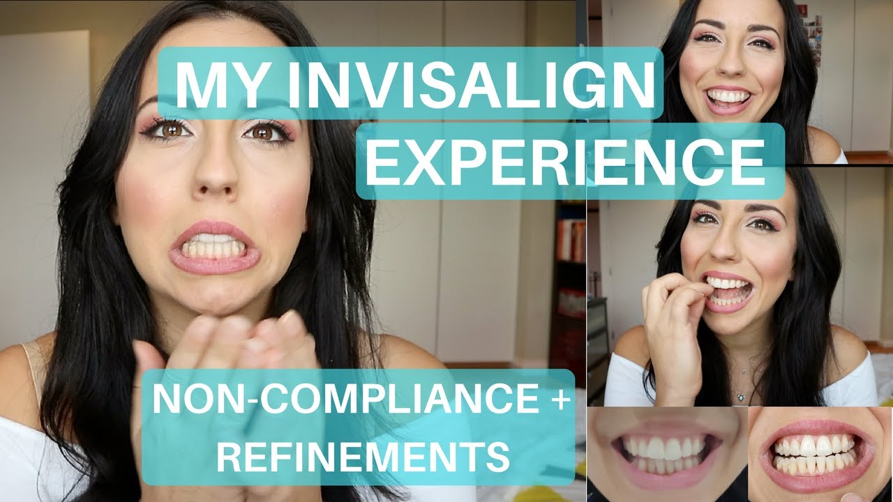 My Invisalign Experience | Non-Compliance + Refinement Trays - YouTube