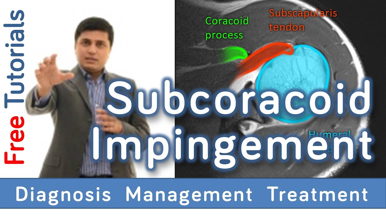 Shoulder pain - Subcoracoid impingement (Adult Orthopaedics) - YouTube