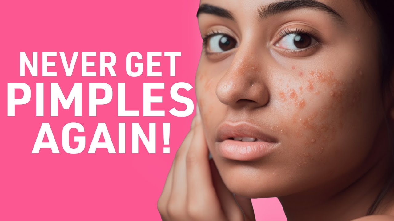 Insecure About ACNE? 😓 | NEVER Get Pimples Again 🥳 | Clear Skin Secrets ...