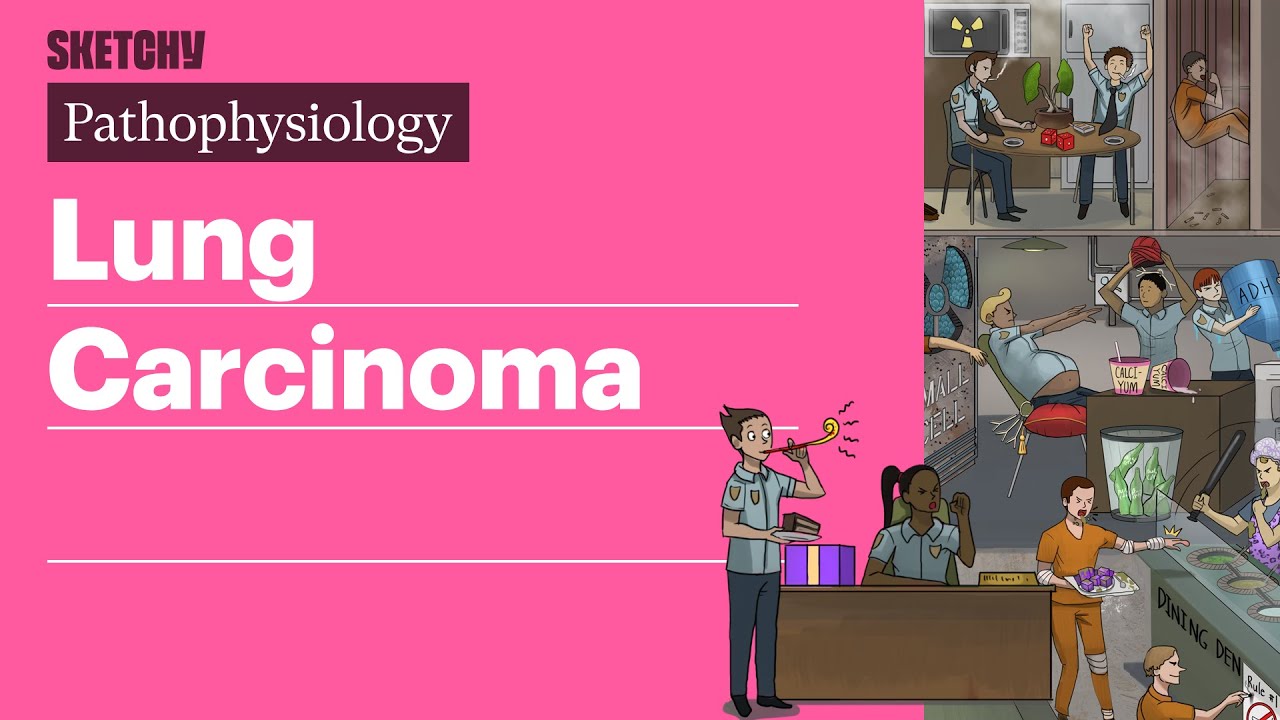 Lung Carcinoma (Pathophysiology) | Sketchy Medical - YouTube