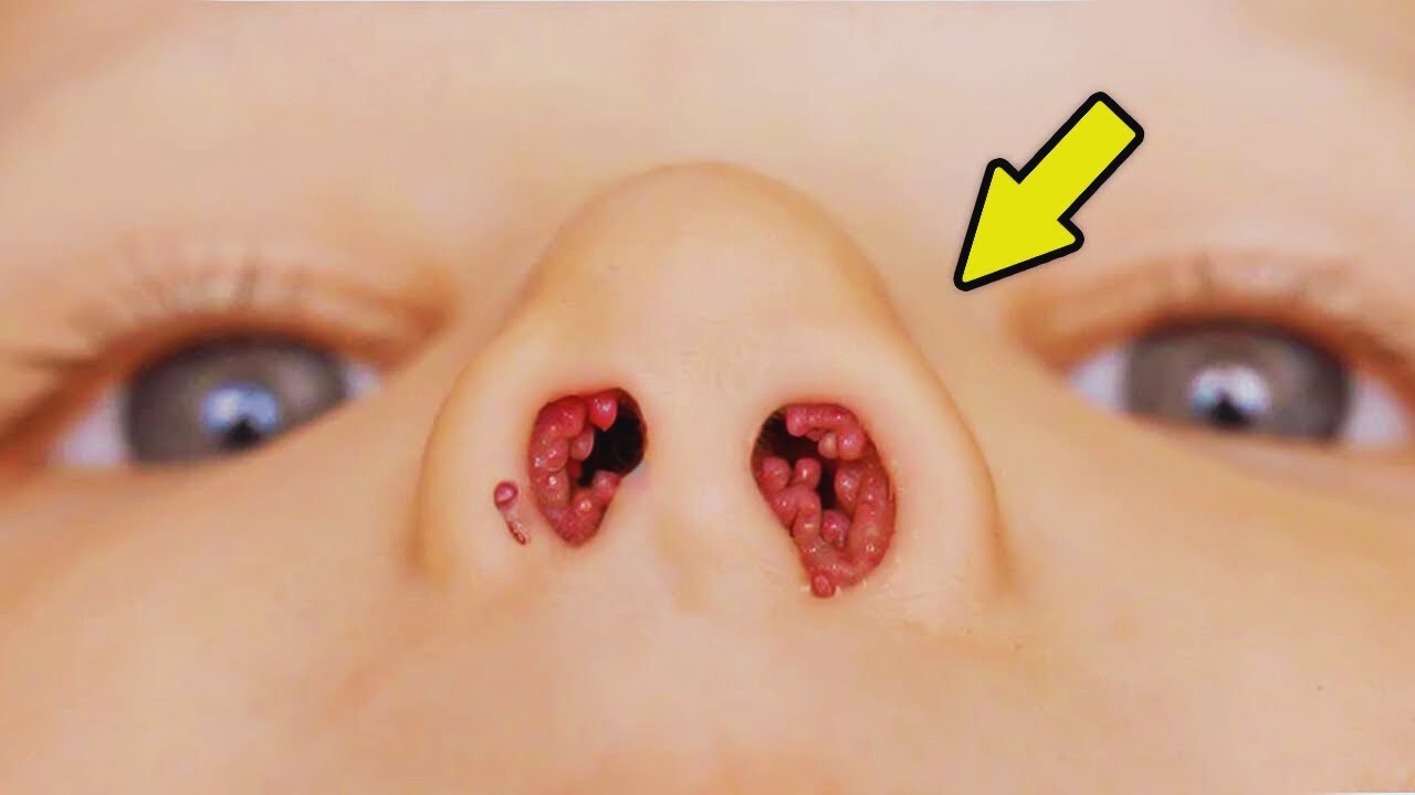 Strange Spots Suddenly Appear Inside Little Girl’s Nose – Then the ...