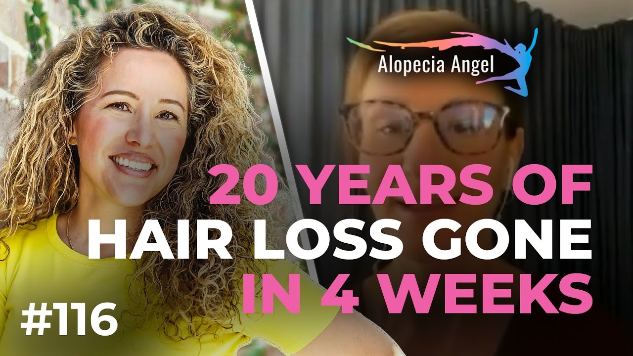 Episode 116: How This Swedish Lady With Female Pattern Baldness Sees ...