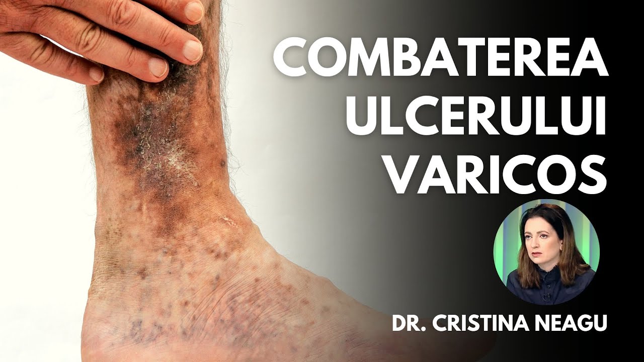 Ulcerul Varicos: Soluții și Informații cu Dr. Cristina Neagu | Sănătate ...