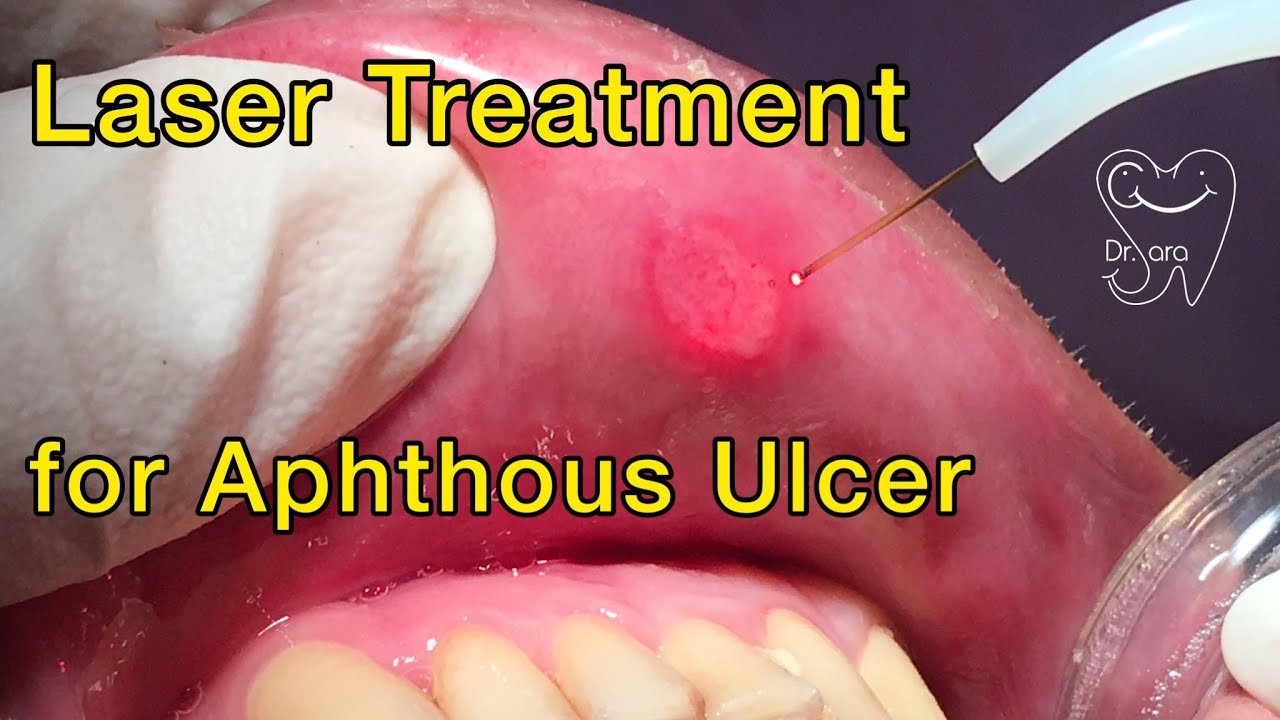 Aphthous Treatment By Laser / Laser Therapy / dentist / Dr Sara the ...