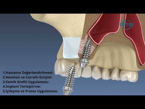 Sinüs operasyonu #sinus #sinusproblems