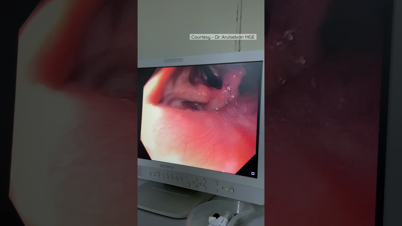 Larynx - epiglottis & vocal cords - scopy view - YouTube