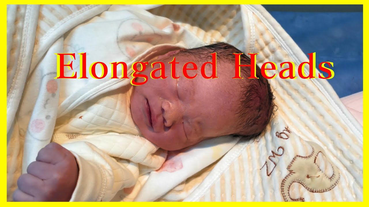 3 Challenging Births: Newborns with Elongated Heads After Difficult ...