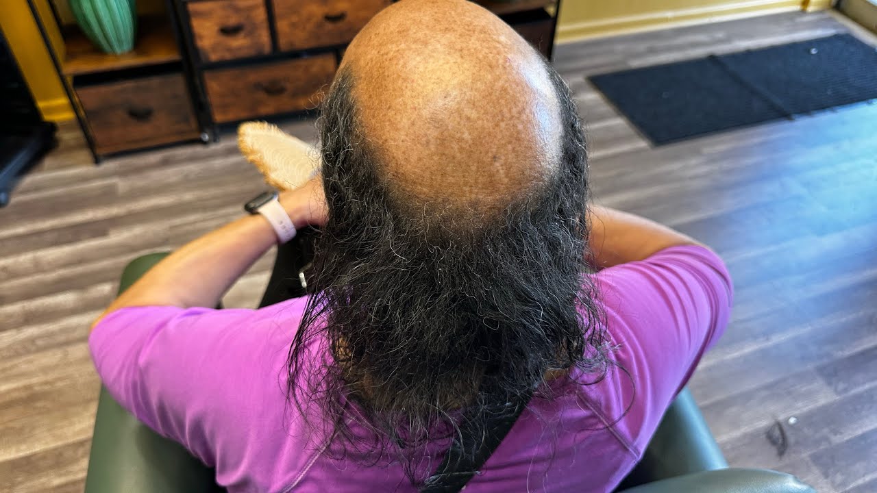 Her hair won’t grow back| Extensions to hide alopecia - YouTube