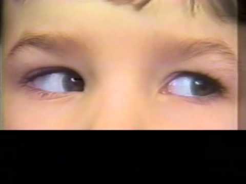 Duane's Syndrome Type 2: Aberrant Regeneration of the Third and Sixth Nerves [ARCHIVE]