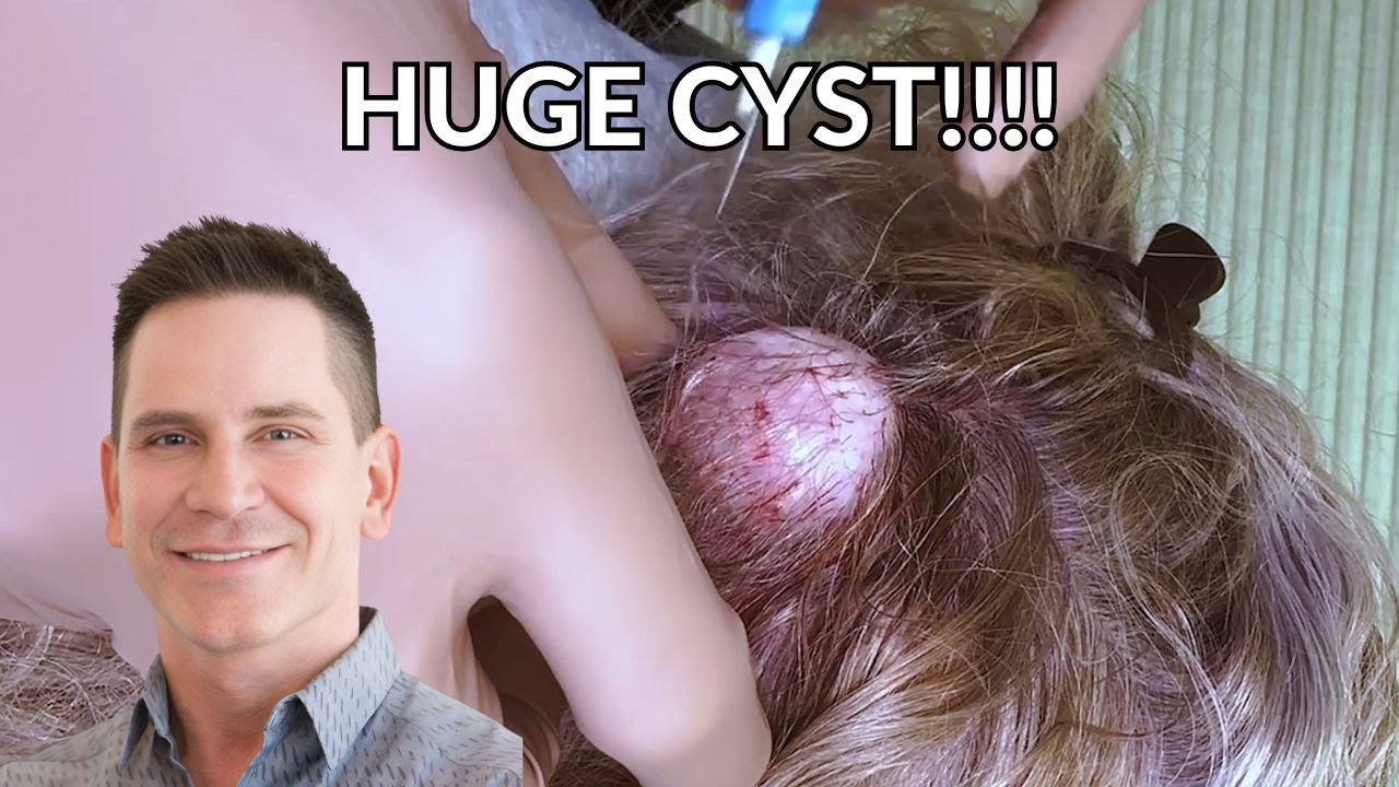 Watch MASSIVE Cyst Get Excised from Patient's Head! | CONTOUR ...