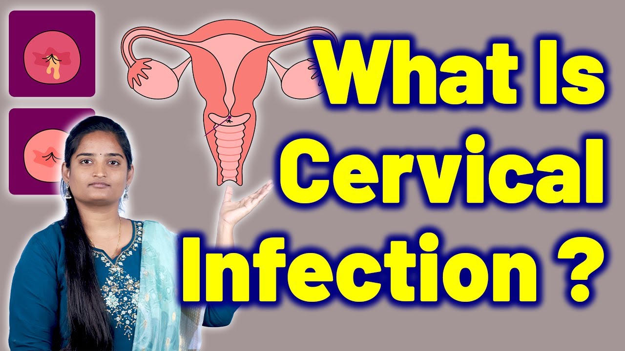 What Is Cervicitis In Women | Cervical Swelling, Infected Cervix, Acute ...