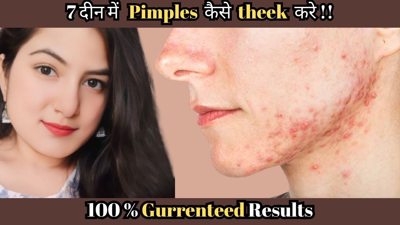 CHALLENGE 2023 : 7 Days Pimple Free Skin || Oily SkinCare Routine - YouTube