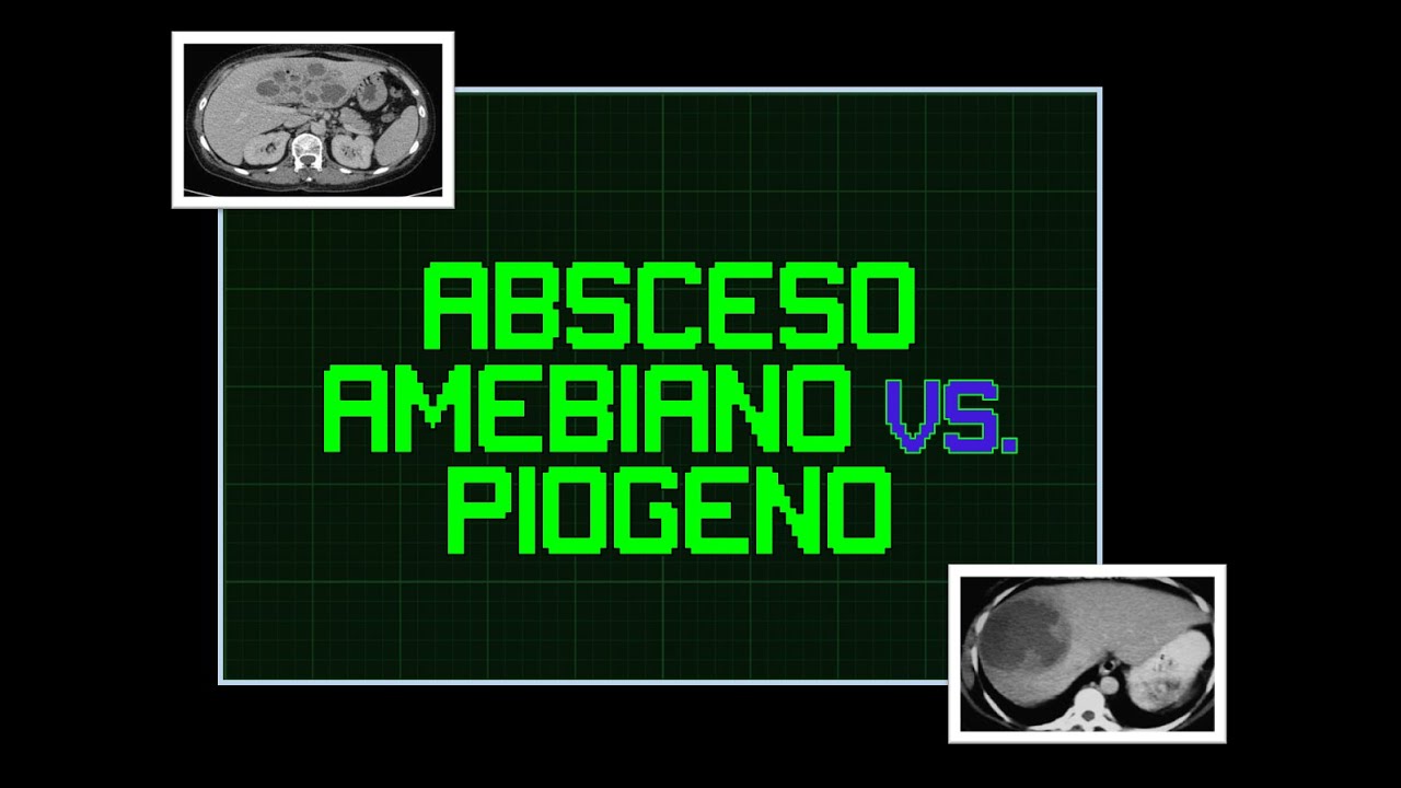Absceso amebiano Vs. Absceso piógeno (Video-Clase 2022/ENARM) - YouTube