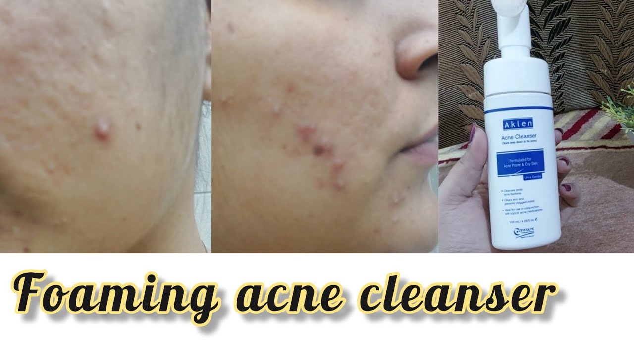 Aklen foaming cleanser for acne, pimples and oily skin (review 2022 ...