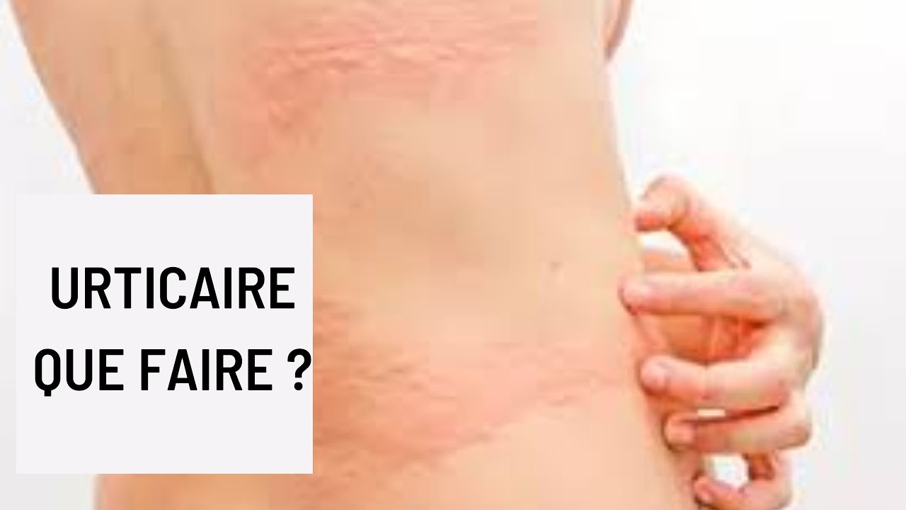 Urticaire : que faire ? - YouTube