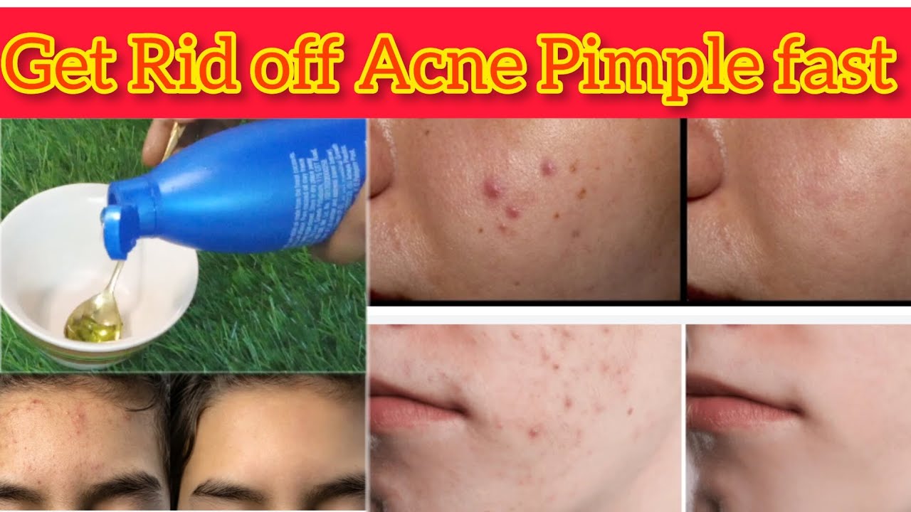 how to get rid of Acne and pimple fast/Acne pimple spot Treatment at ...