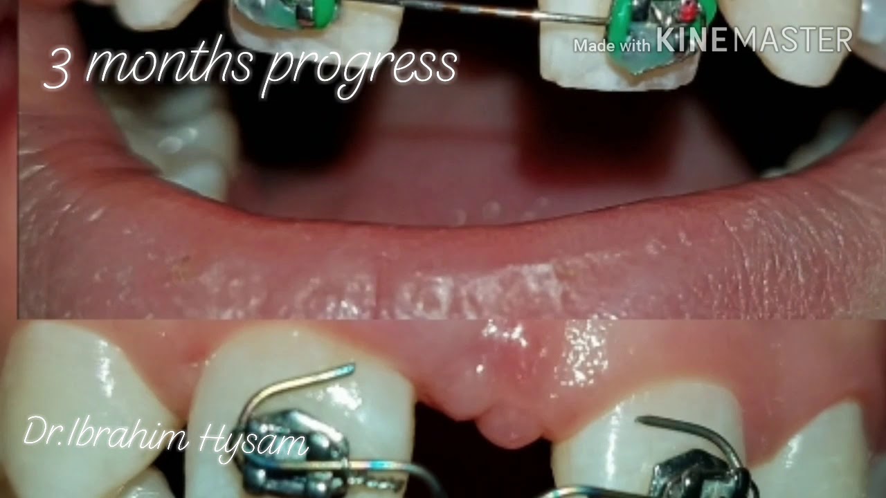 Closing large diastema by orthodontics - YouTube