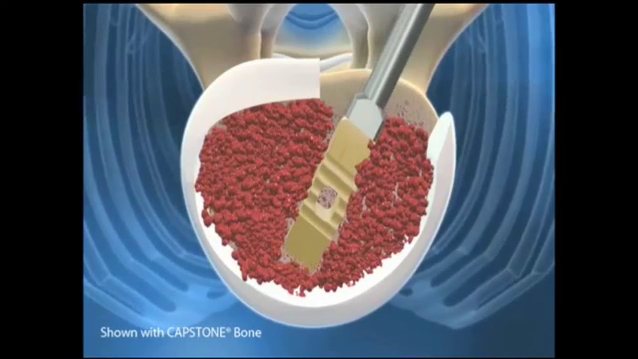 MIS TLIF (Minimally Invasive Lumbar Decompression and Instrumentation ...