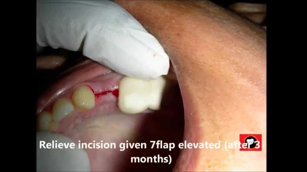 TWO STAGE IMPLANT TECHNIQUE DENTAL IMPLANTS IN CHENNAI YouTube two-stage-implant-technique-dental-implants-in-chennai-youtube