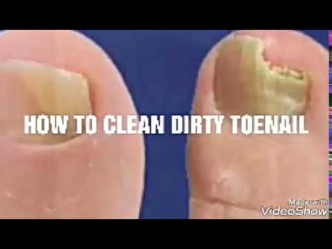 How to clean dirty Toenail? - YouTube