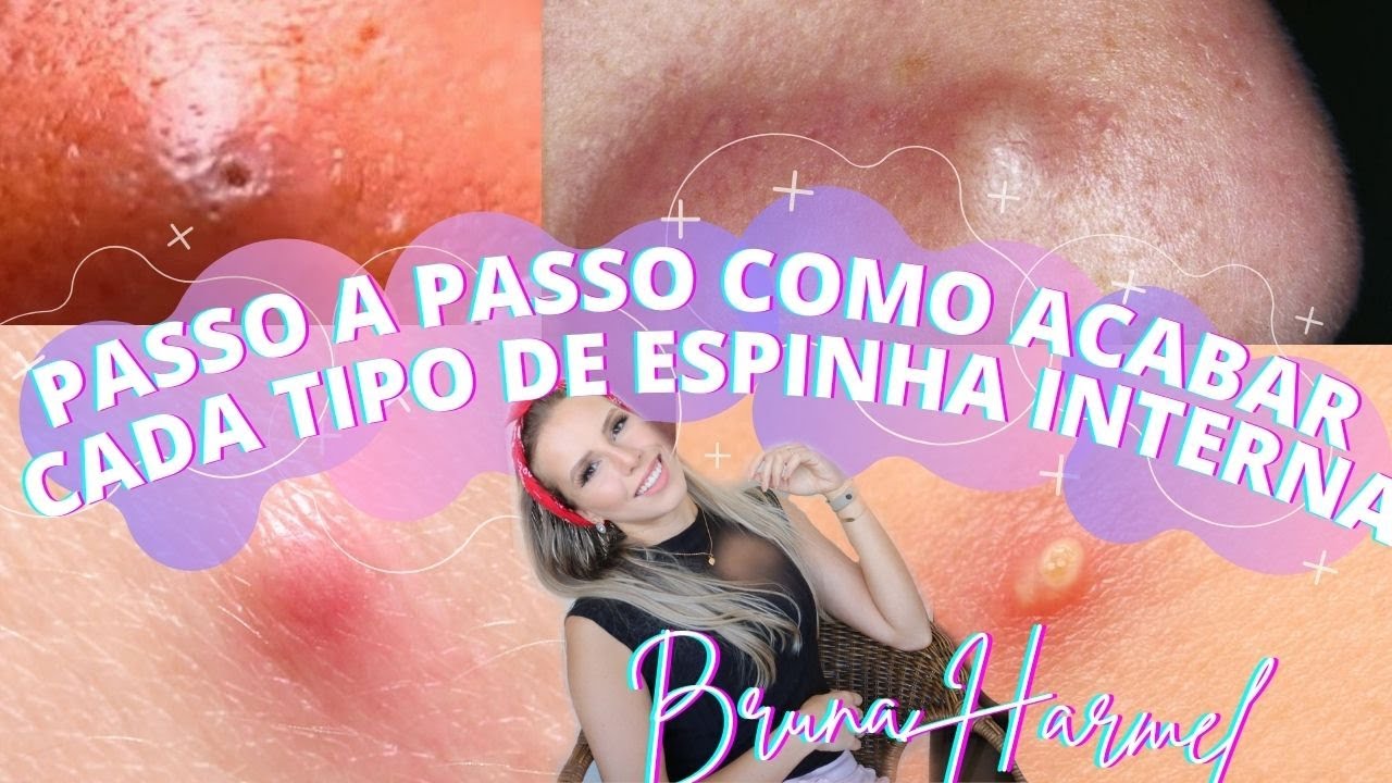 PASSO A PASSO PARA TIRAR ESPINHAS INTERNAS DE TODOS OS TIPOS - Bruna ...