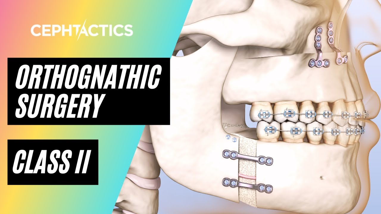 Indications for orthognathic surgery in Class II - YouTube