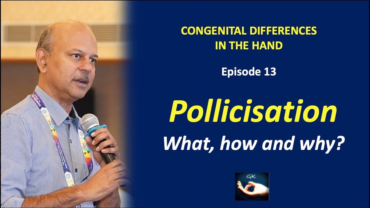 Congenital hand: Episode 13 - How is POLLICISATION done - The what, the ...