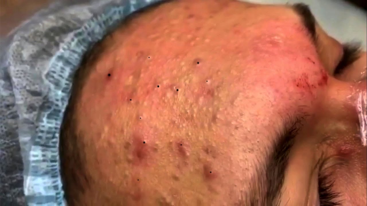 Acne Fulminans Sac Dep Spa Newest Youtube