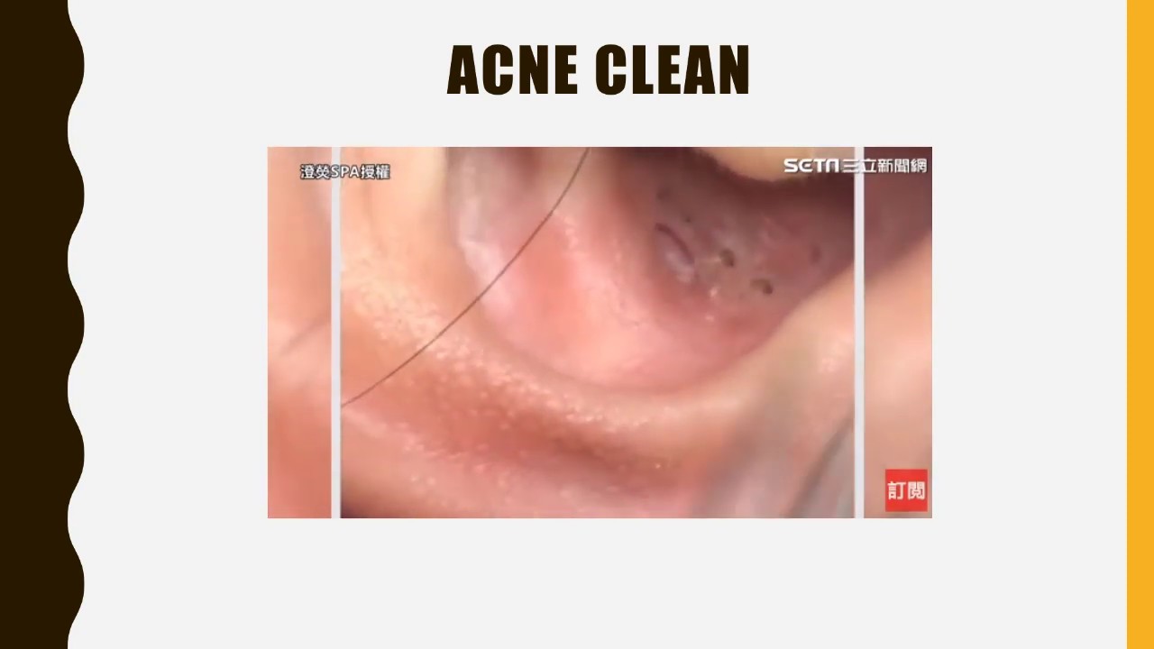 Acne Clean best treatment ការសំអាតមុខមុន #06(Acne Clean) - YouTube
