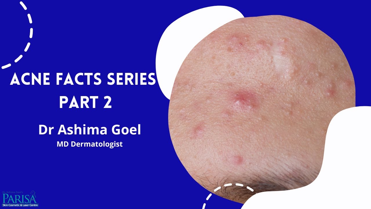Hypertrophic scarsi Acne: Fact Series - Part 2 | Dr. Ashima Goel - Skin ...