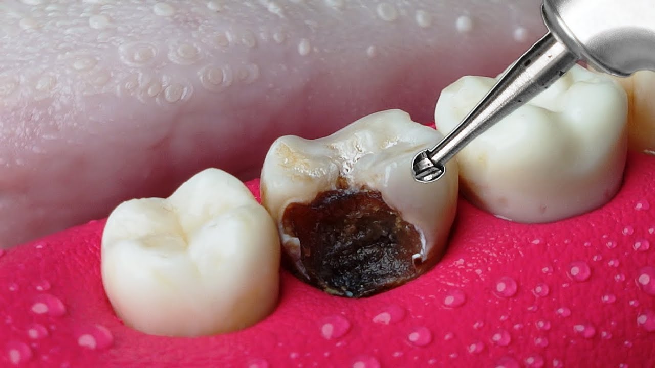 ASMR Restoration! Incredible Tooth Cavity And The Master Dentist - YouTube