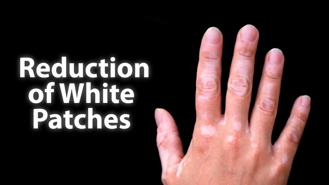 Reduction of White Patches - YouTube