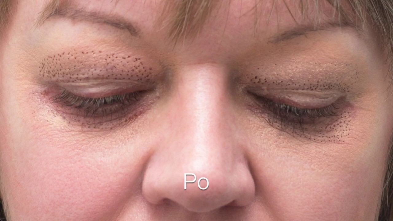 Lifting powiek - zabieg na opadające powieki górne - jak je skutecznie ...