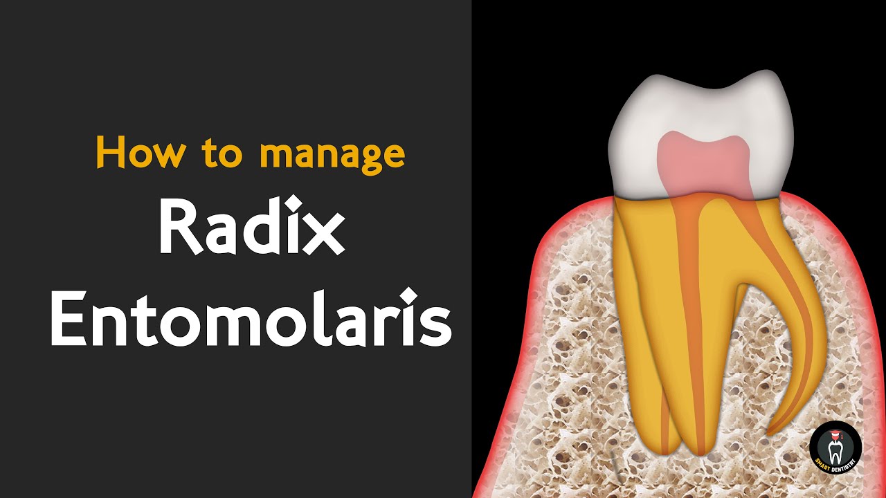 Radix entomolaris | Easy technique - YouTube