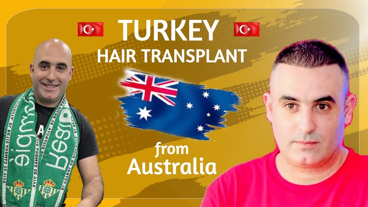 My first Hair Transplant in Turkey coming from Australia!!! 🇦🇺 to 🇹🇷 ...