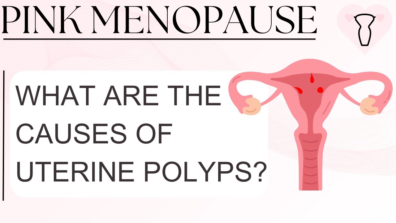 PINK MENOPAUSE - Causes of Uterine Polyps Explained – Key Info for ...