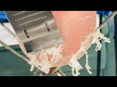 Exploring Extreme Foot Callus Removal Techniques - YouTube