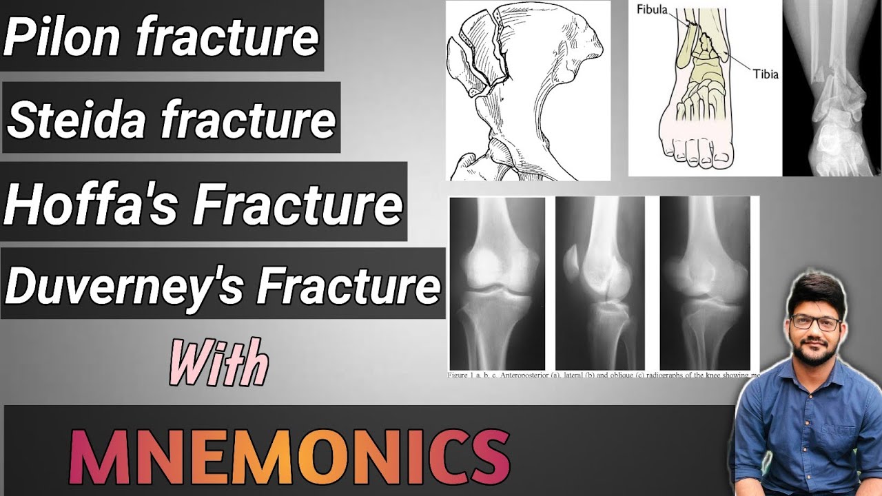Duverney Fracture